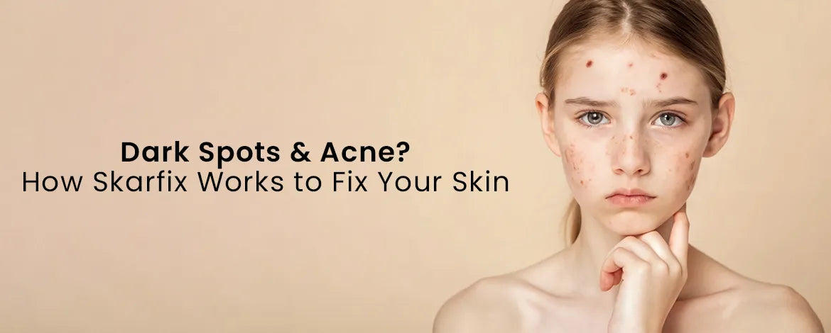 Dark Spots & Acne? How Skarfix Works to Fix Your Skin – Fixderma Skincare