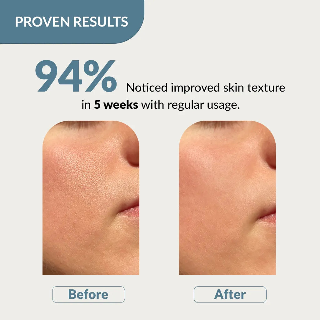 Use Fixderma Hyaluronic Acid Serum to minimize Open Pores – Fixderma ...